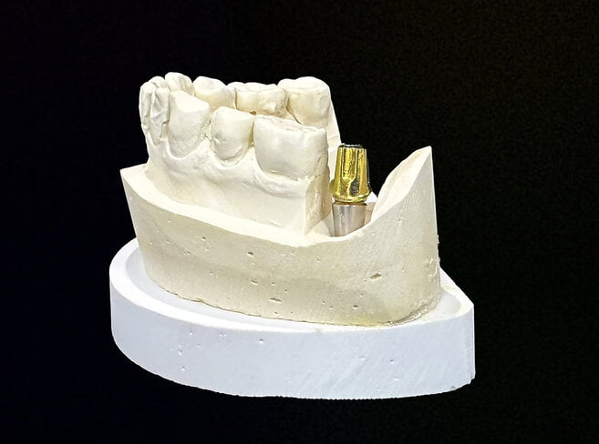 Customized Abutment - VTA Dental Lab