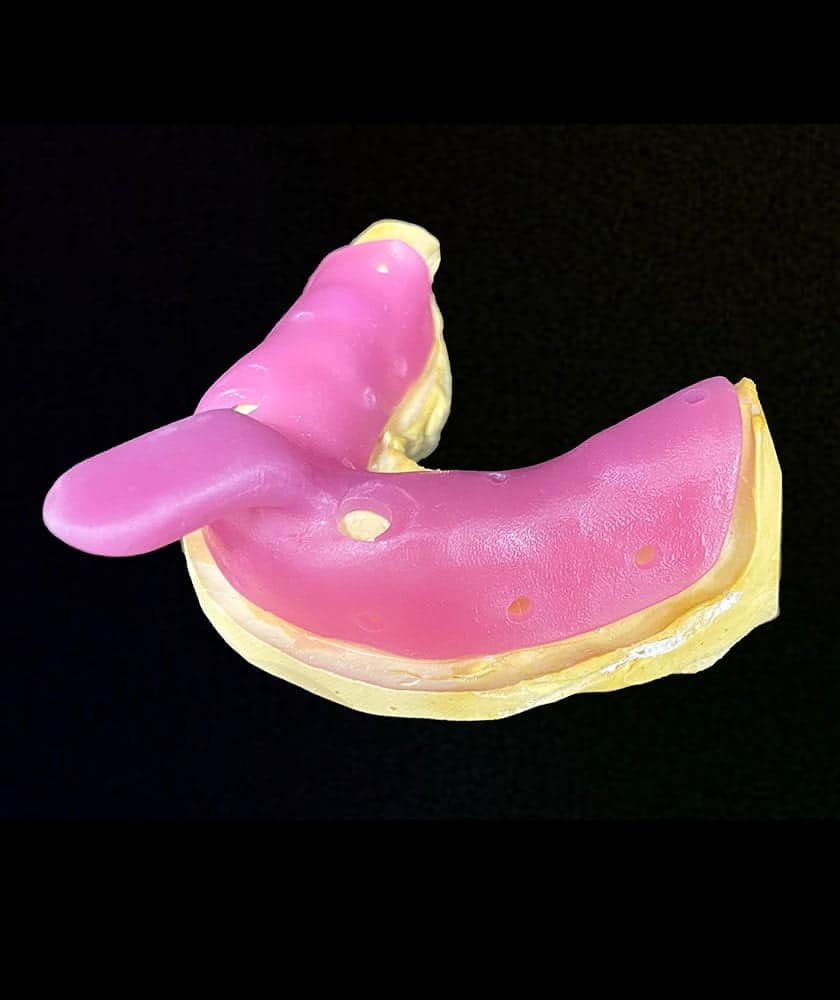 CUSTOM TRAY - VTA Dental Lab