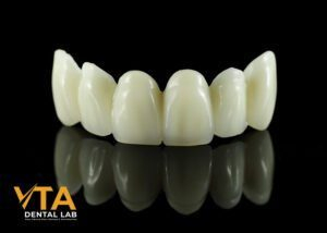 Accurate Understanding Of Anterior Bridge – VTA Dental Lab