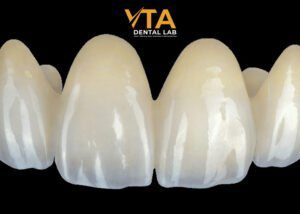 Accurate Understanding Of Anterior Bridge - VTA Dental Lab