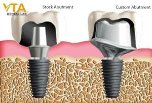 What Is A Custom Abutment? Benefits And Technology Behind It - VTA ...