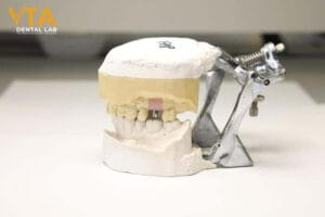 What Is A Custom Abutment? Benefits And Technology Behind It - VTA ...