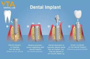 The Dental Abutment Placement Process: Steps To Success In Implant ...