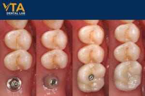 Dental Implant Healing Stages: A Complete Guide