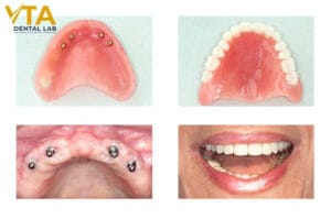 A Step-by-Step Guide to the Denture Implant Procedure – VTA Dental Lab
